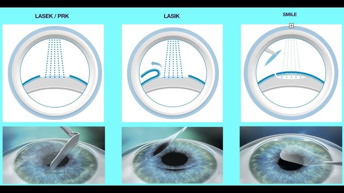 ZEISS SMILE: भारत में तेजी से अपनाई जा रही है दृष्टिदोष को ठीक करने की ...